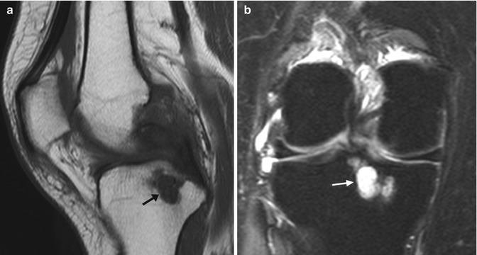 Bone Tumors: MRI Pitfalls | SpringerLink