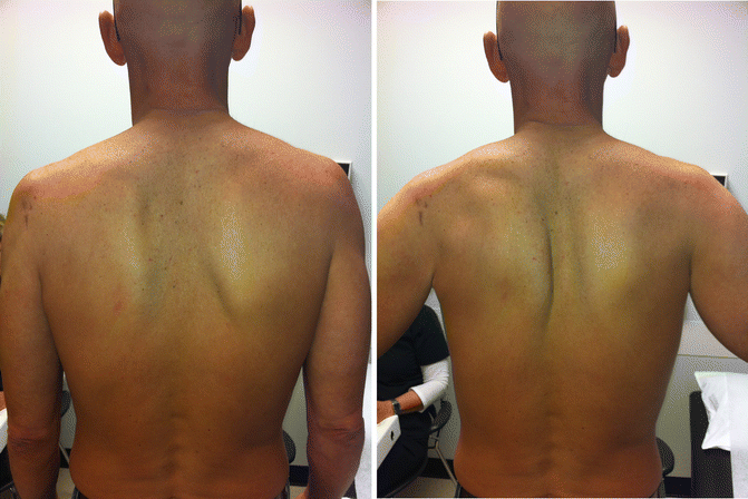 Neurologic-Based Injuries and Scapula Winging | SpringerLink