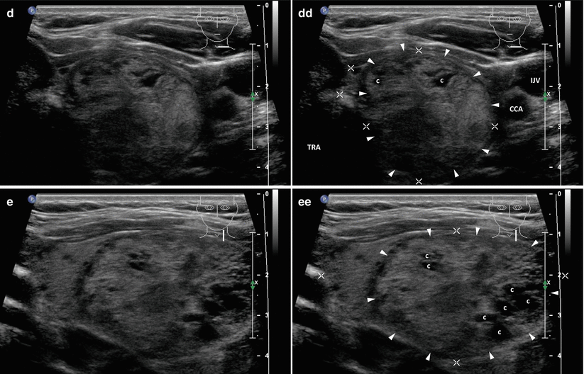 Multinodular Goiter | SpringerLink