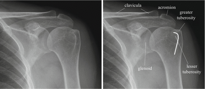 Internal Rotation Shoulder Xray