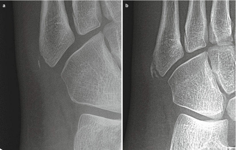 Pediatric Musculo-Skeletal Trauma: What is Unique and What Not to Miss ...