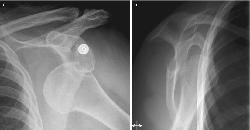 Shoulder: Glenohumeral Instability | SpringerLink