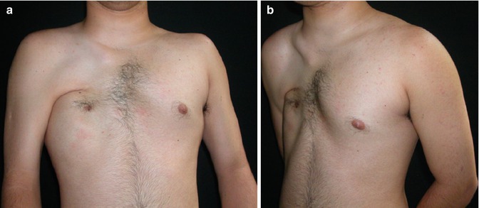 Poland’s Syndrome | SpringerLink