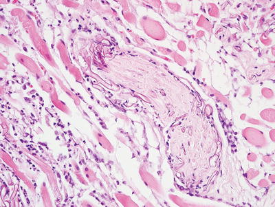 Fungal Infections | SpringerLink