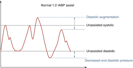 Intra-aortic Balloon Pump (IABP) | SpringerLink