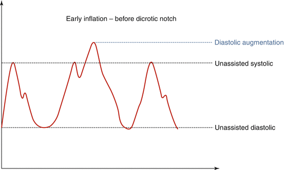 Intra-aortic Balloon Pump (IABP) | SpringerLink