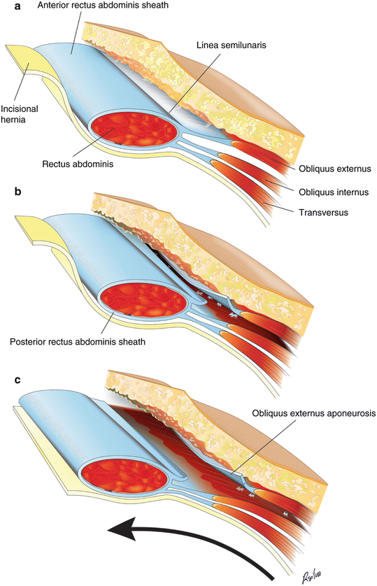 Minimally Invasive Component Separation for the Repair of Large ...