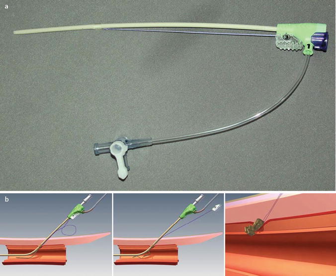 Manual, Mechanical, and Device Hemostasis | SpringerLink