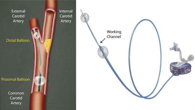 Recent Advances in Carotid Artery Stenting | SpringerLink