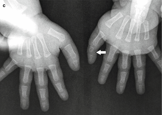 Polydactyly | SpringerLink