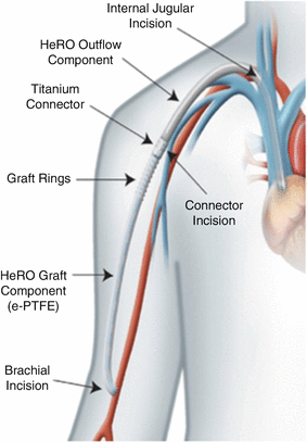 Exotic Arteriovenous Graft Creation | SpringerLink