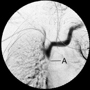 Swollen Arm with Suspected Arteriovenous Graft Infection | SpringerLink