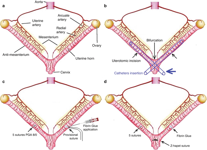 Uterine Morbidity: Cesarean Section Scar Complications | SpringerLink