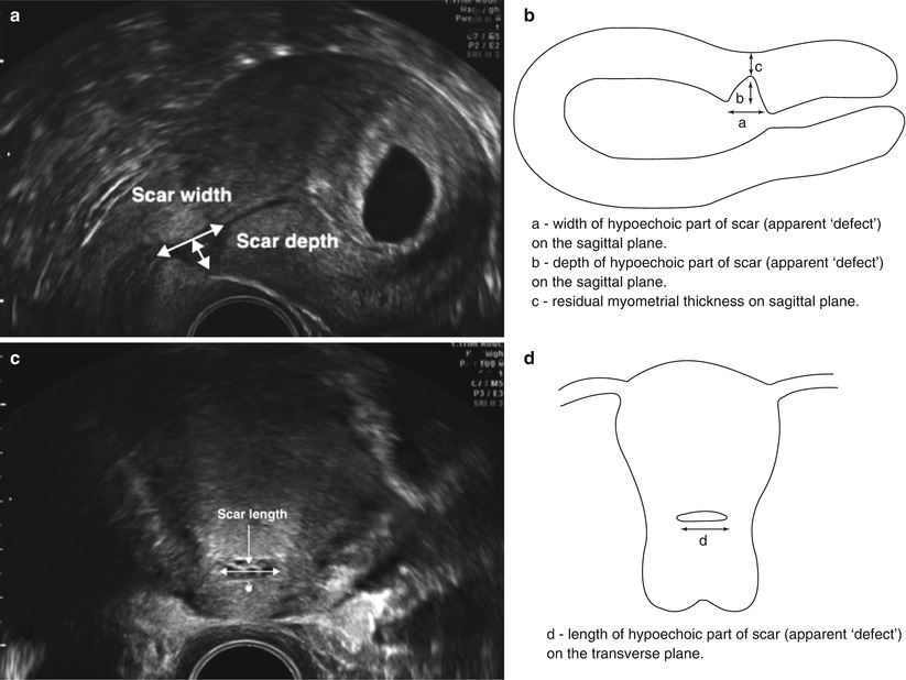 Uterine Morbidity: Cesarean Section Scar Complications | SpringerLink