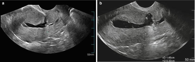 Uterine Morbidity: Cesarean Section Scar Complications | SpringerLink
