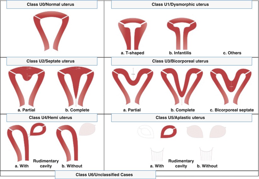 What’s New About Classification of Female Genital Anomalies? | SpringerLink