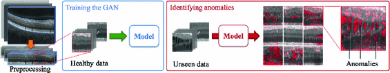 Unsupervised Anomaly Detection with Generative Adversarial Networks to Guide Marker Discovery ...