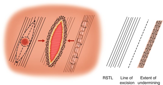Elliptical Excision and Sliding Flap Repair | SpringerLink