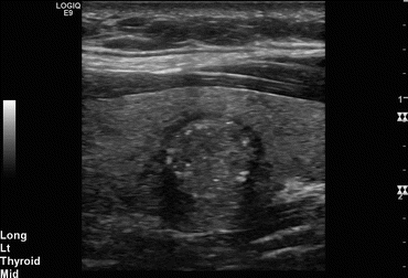 Imaging for Thyroid Nodules | SpringerLink