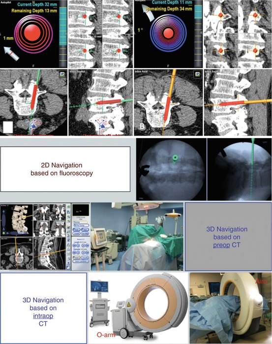 The Role of Neuronavigation in Lumbar Spine Surgery | SpringerLink