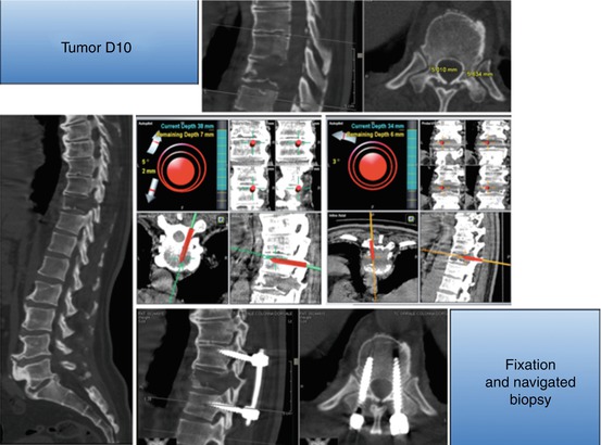 The Role of Neuronavigation in Lumbar Spine Surgery | SpringerLink