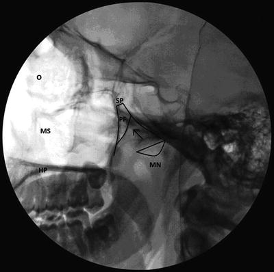 Sphenopalatine Ganglion Blocks | SpringerLink