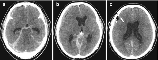 Management of Hydrocephalus Following SAH and ICH | SpringerLink
