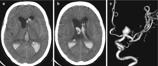 Management of Hydrocephalus Following SAH and ICH | SpringerLink