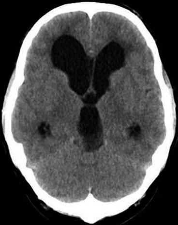 Radiological Diagnosis of Hydrocephalus | SpringerLink