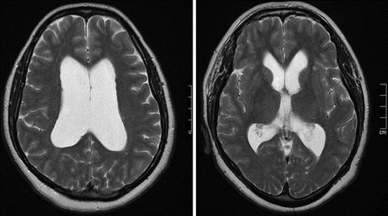 Radiological Diagnosis of Hydrocephalus | SpringerLink