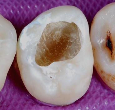 Selective Removal of Carious Dentin | SpringerLink