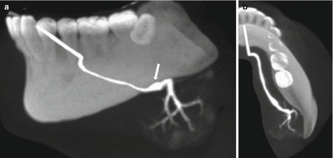 CBCT Sialography | SpringerLink