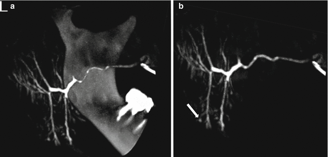 CBCT Sialography | SpringerLink