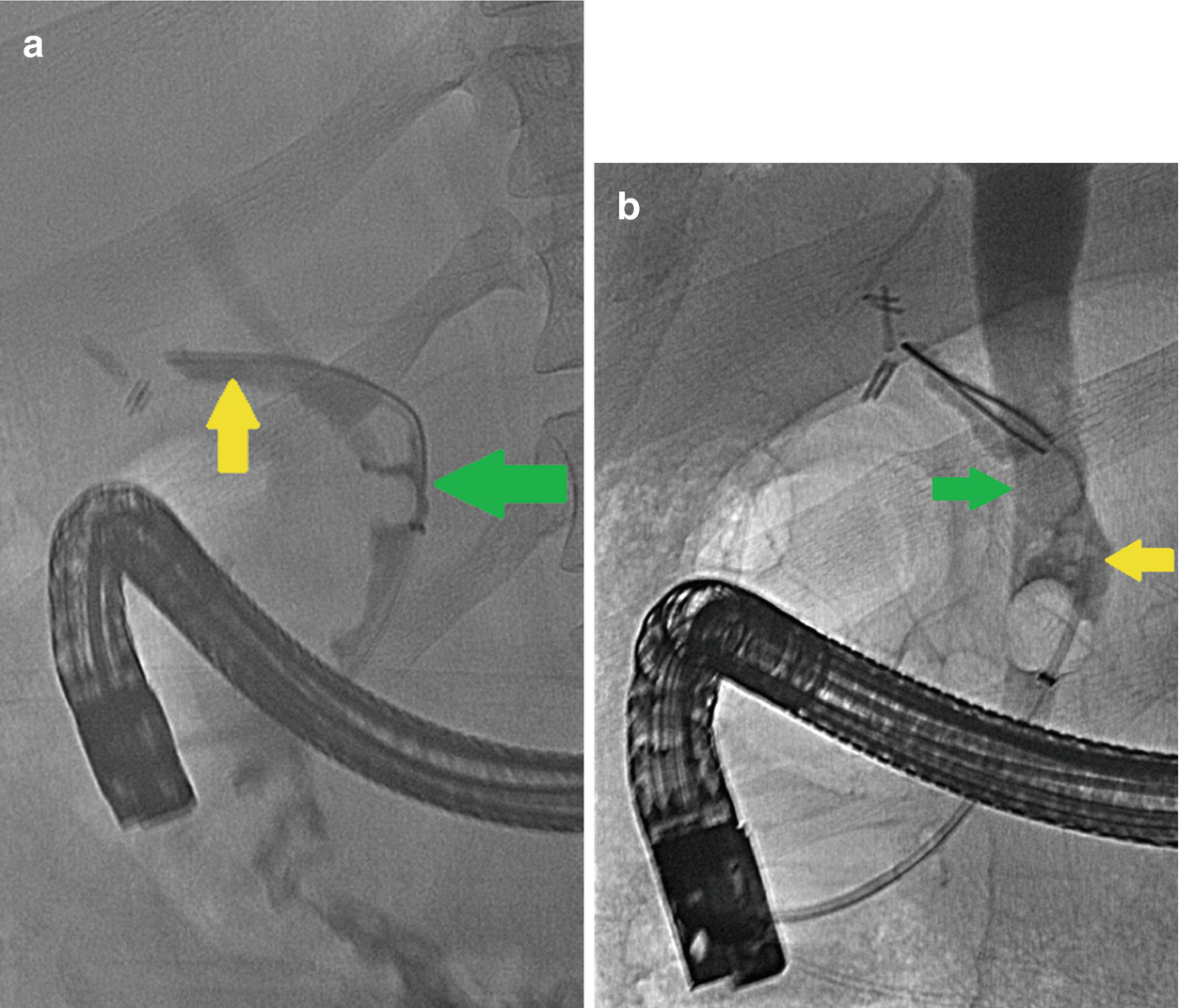 Post Cholecystectomy Symptoms | SpringerLink