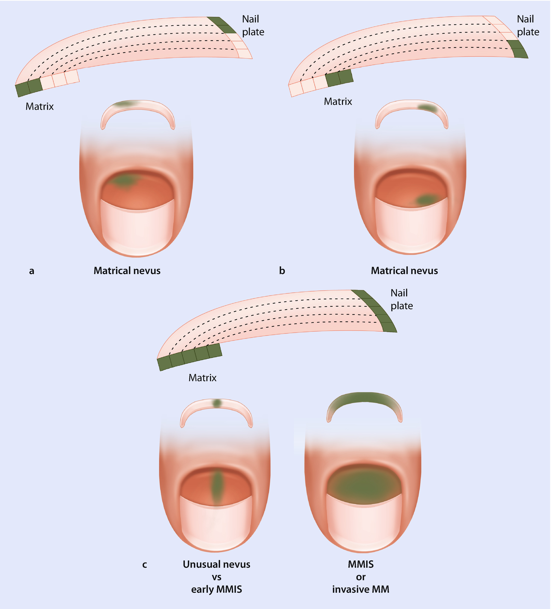 Normal Nail Anatomy, Normal Nail Histology, and Common Reaction ...