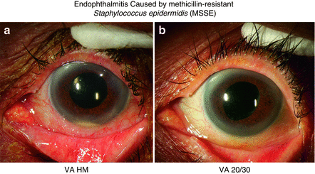 Endophthalmitis: Classification and Most Frequently Reported Organisms ...
