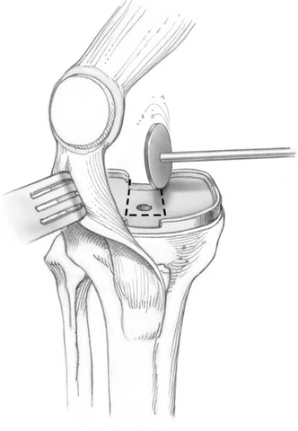 Removal of the Femoral and Tibial Components for Revision Total Knee ...