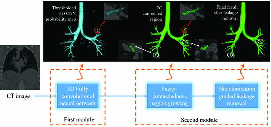 3D Convolutional Neural Networks with Graph Refinement for Airway Segmentation Using Incomplete ...
