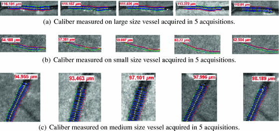 Validation Study on Retinal Vessel Caliber Measurement Technique ...