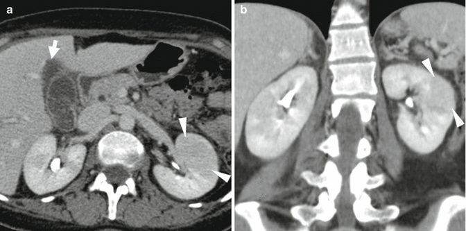 CT Imaging and Differential Diagnosis of Acute Pyelonephritis ...