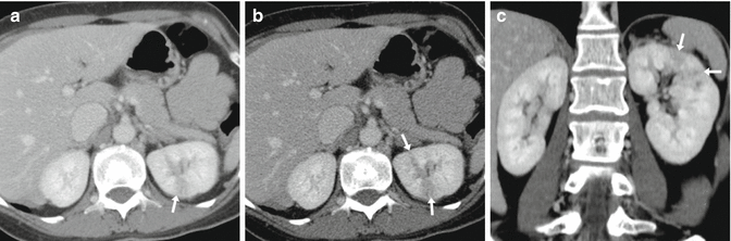 CT Imaging and Differential Diagnosis of Acute Pyelonephritis ...