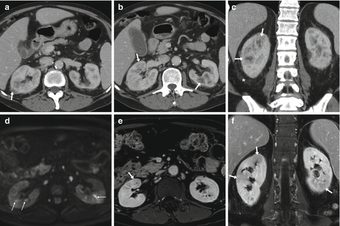 CT Imaging and Differential Diagnosis of Acute Pyelonephritis ...