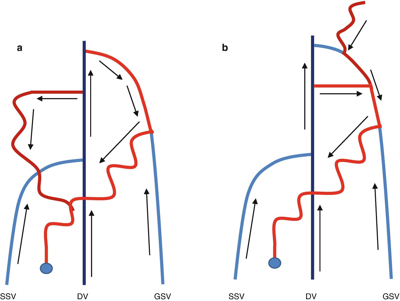 Venous Reflux Patterns | SpringerLink
