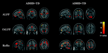 Abnormal Brain Activity in ADHD: A Study of Resting-State fMRI ...