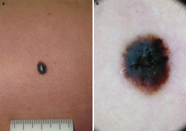 Spitz/Reed Nevus | SpringerLink