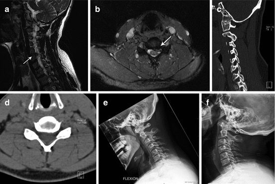 Posterior Cervical Foraminotomy | SpringerLink