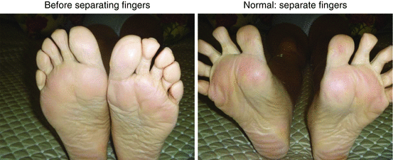 Vascular and Neuropathic Foot | SpringerLink