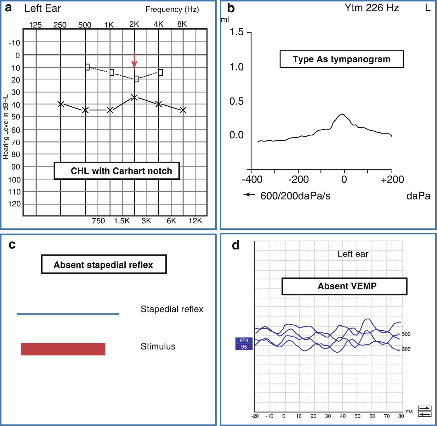 Otosclerosis | SpringerLink