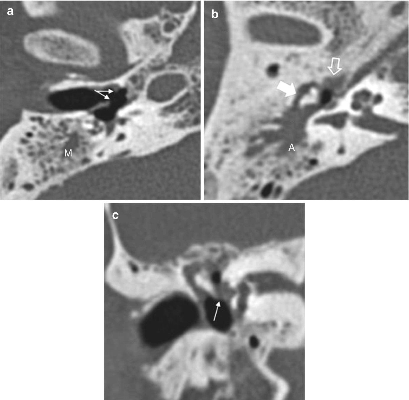 Chronic Suppurative Otitis Media (CSOM): A Middle Ear Mucosal Disease | SpringerLink