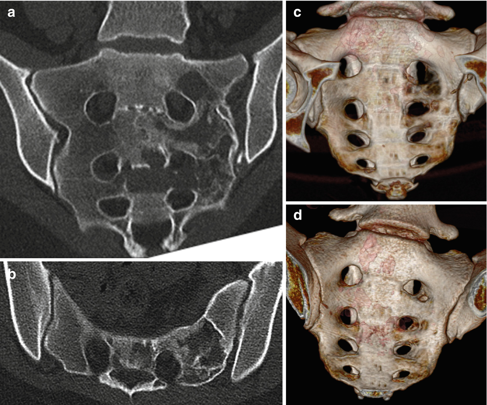 Sacral Aneurysmal Bone Cyst | SpringerLink
